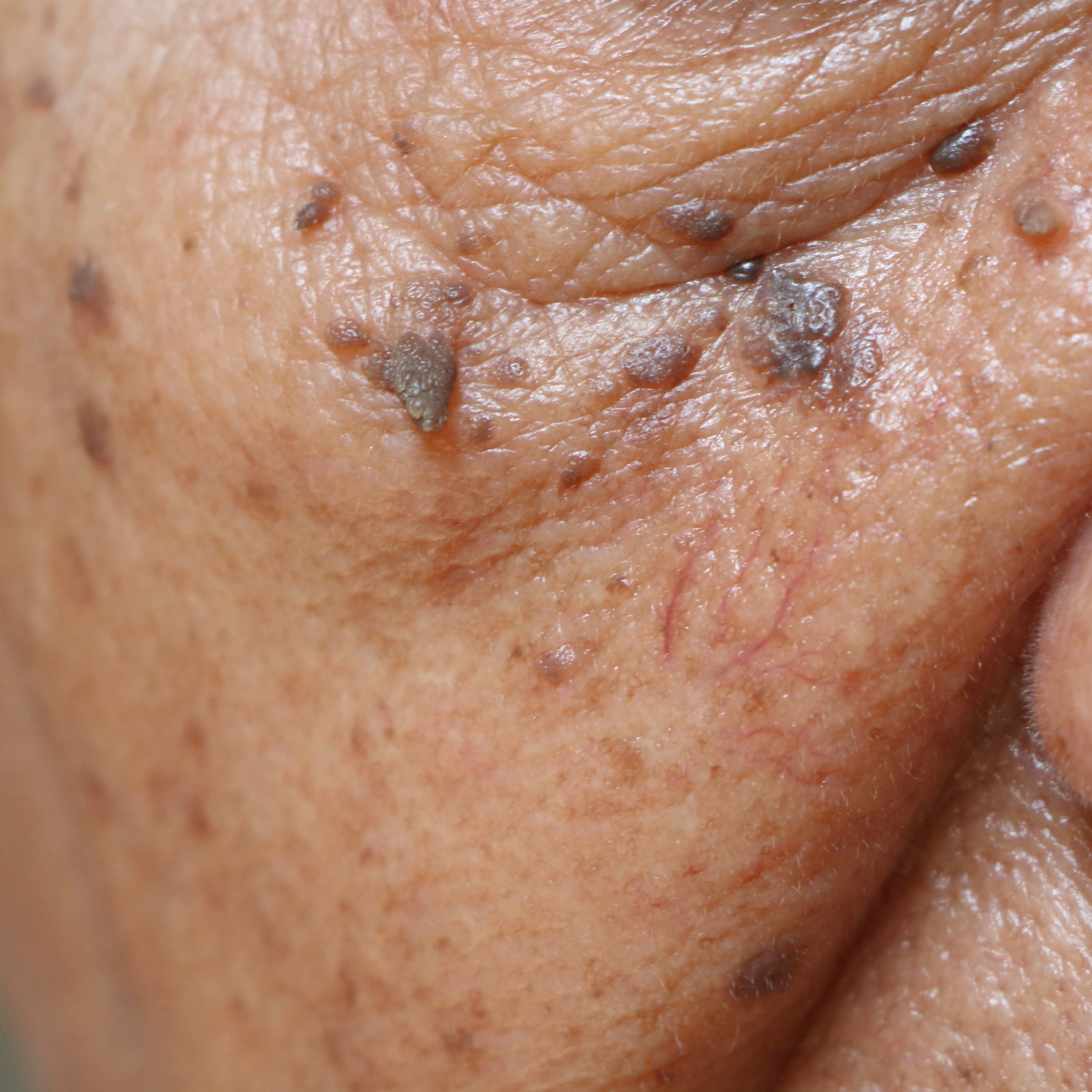 Wart & Skin Tag Removal Kent | Canterbury Skin and Laser Clinic