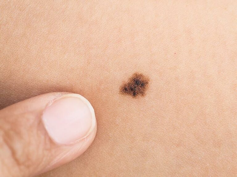 Moles | Canterbury Skin and Laser Clinic