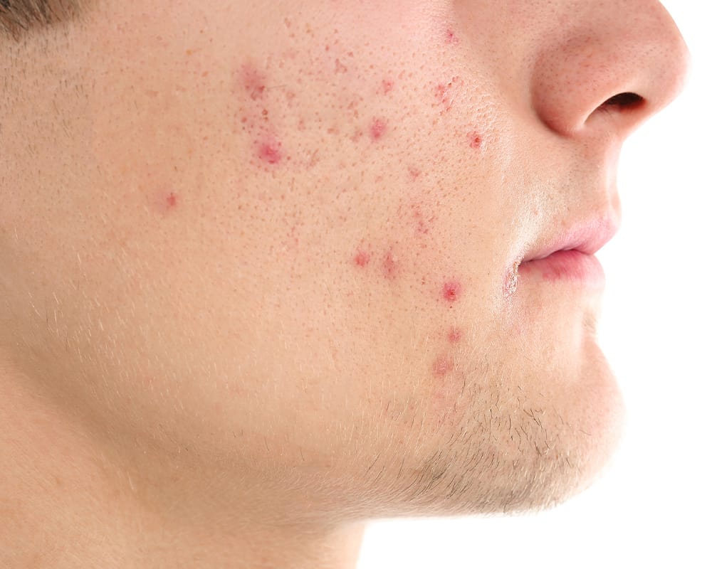 Acne Treatment | Canterbury Skin and Laser Clinic
