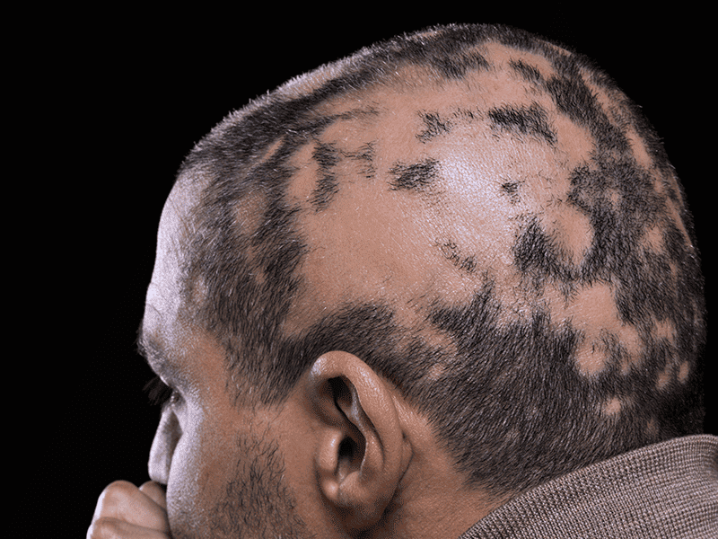 Alopecia Hair Loss | Canterbury Skin and Laser Clinic