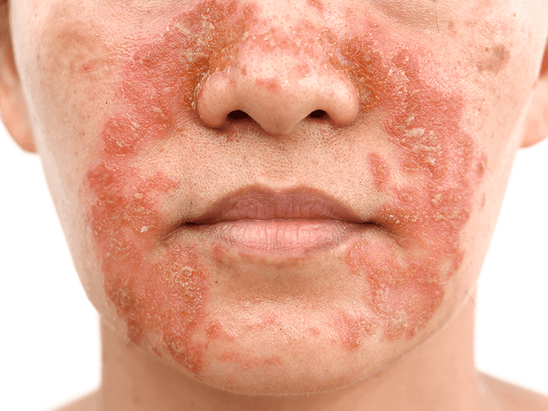 Eczema and Skin Rashes | Canterbury Skin and Laser Clinic