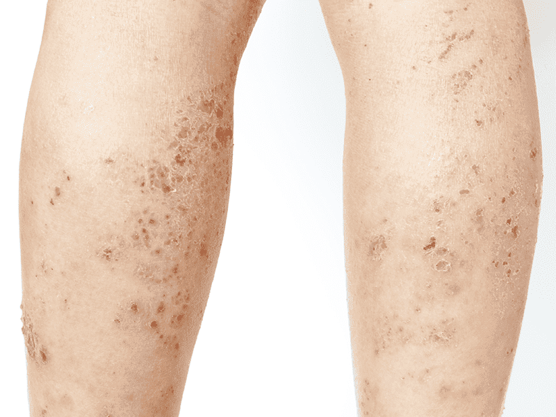 Lichen Planus | Canterbury Skin and Laser Clinic