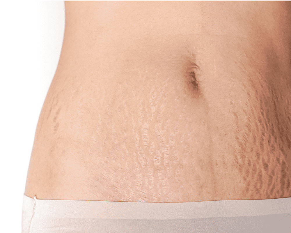 Fractional Laser Skin Resurfacing | Canterbury Skin and Laser Clinic