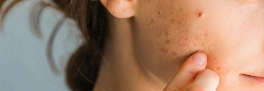 Understanding Acne: A Deep Dive For Acne Awareness Month